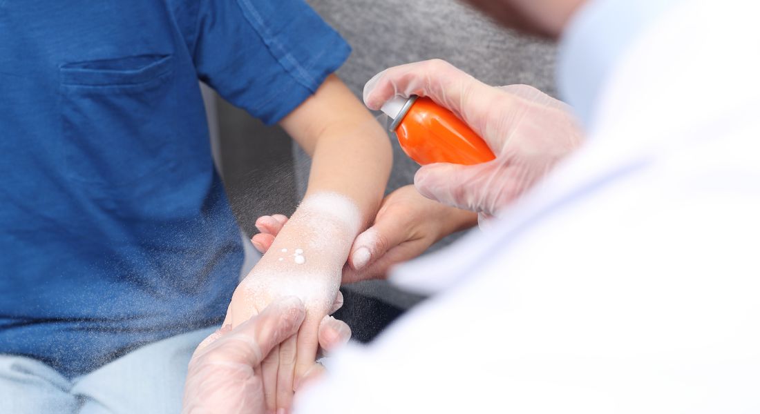 Pediatric Burn Treatment, Management, and Care | Management of Burns in ...