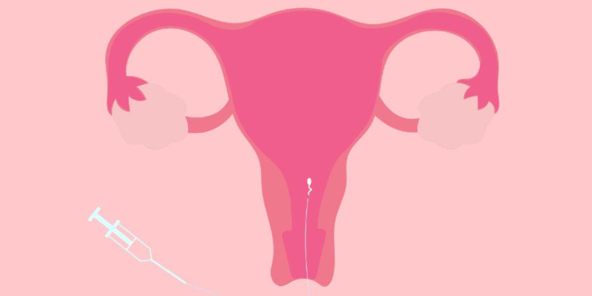A Step-by-Step Guide to IUI Treatment | What is IUI Treatment and How ...