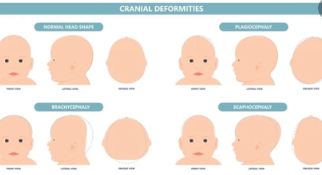 Skull Deformity in Children | Abnormal Skull Shape in Children