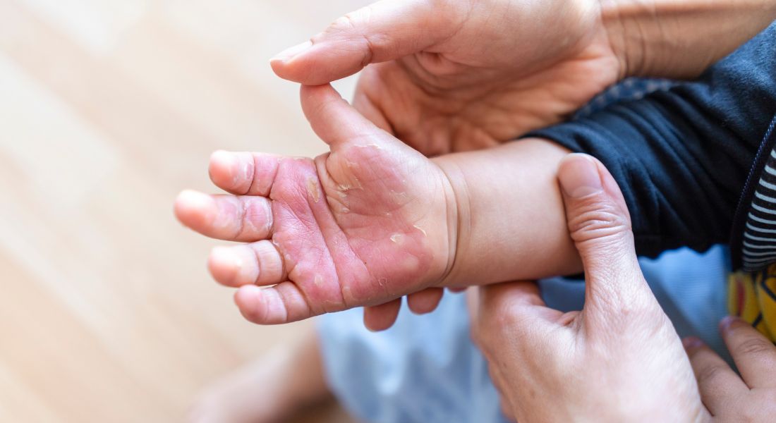 Pediatric Burn Treatments | Pediatric Burn Care and When to Visit a Doctor?